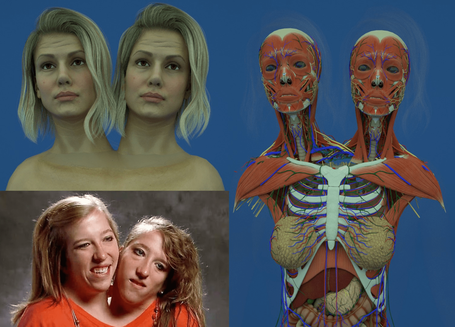 A Bond Beyond Biology: The Inspiring Life of Conjoined Twins Living in ...